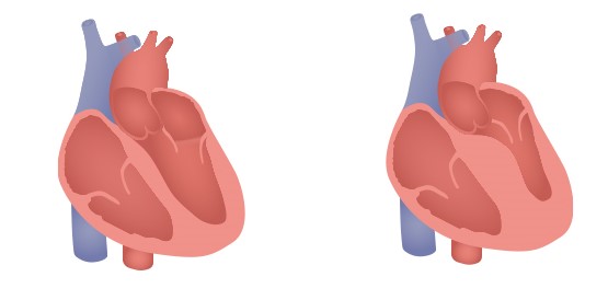 Congestive Heart Failure